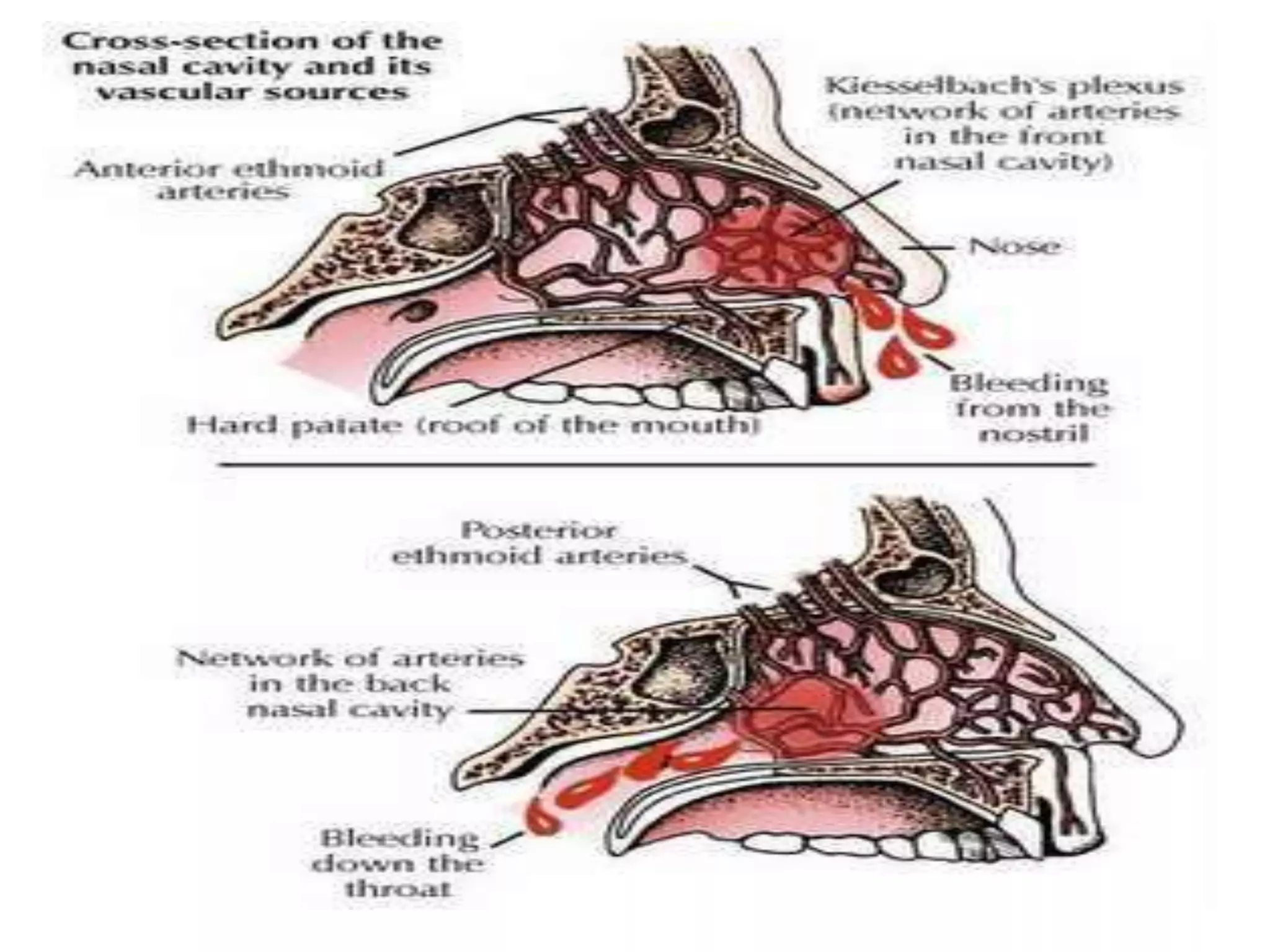 EPISTAXIS.pptx