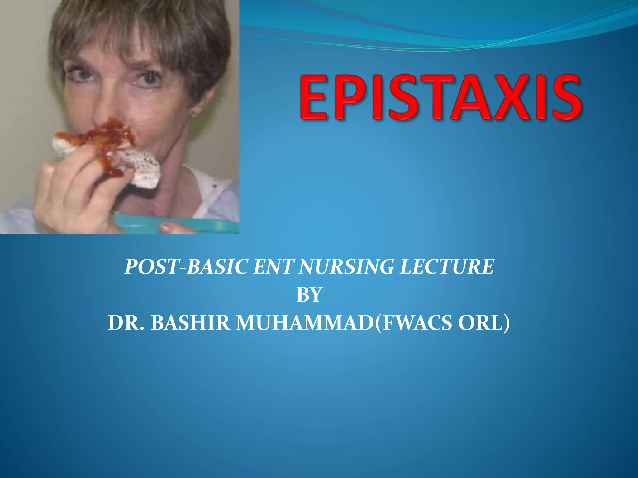 EPISTAXIS | PPTX