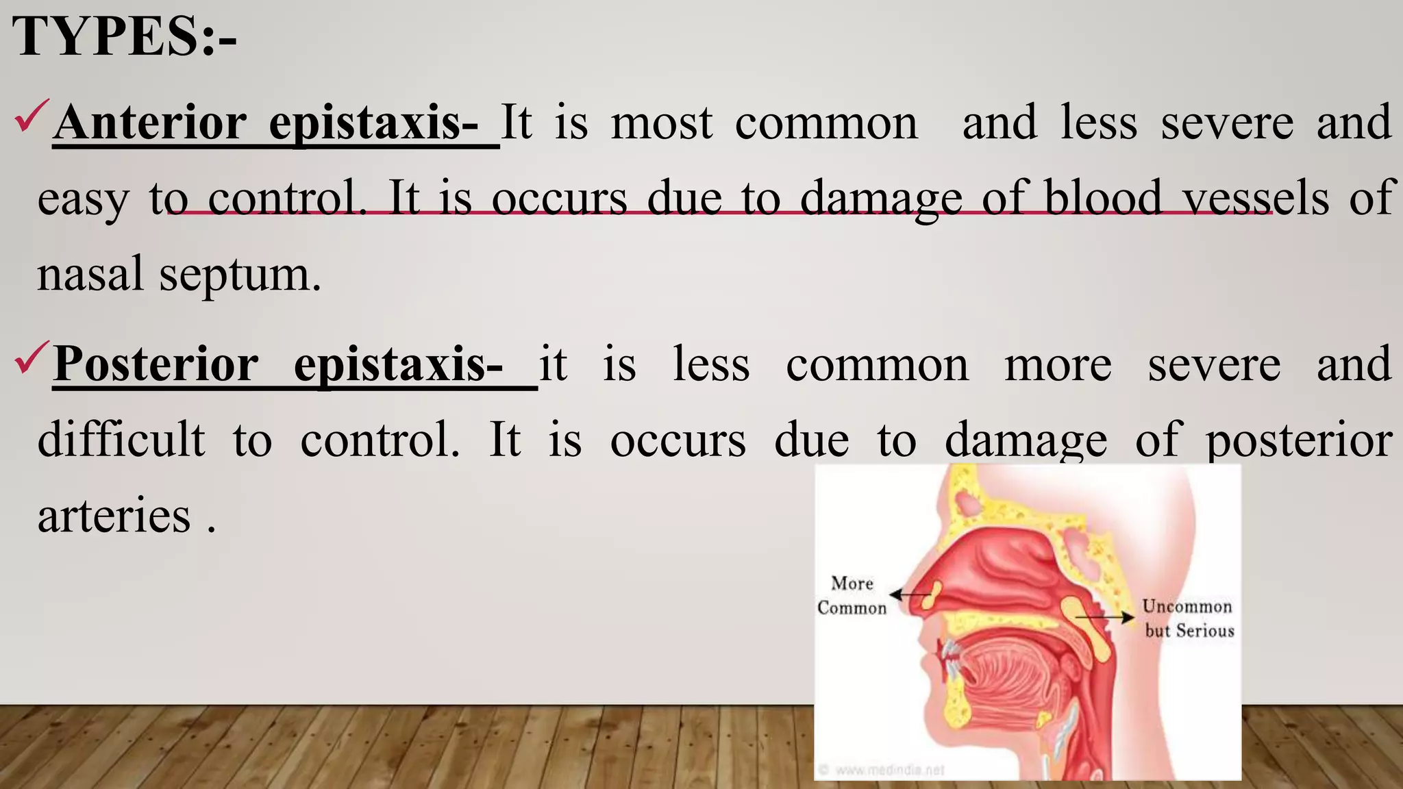 Epistaxis.pptx