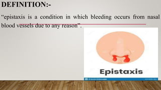 Epistaxis.pptx