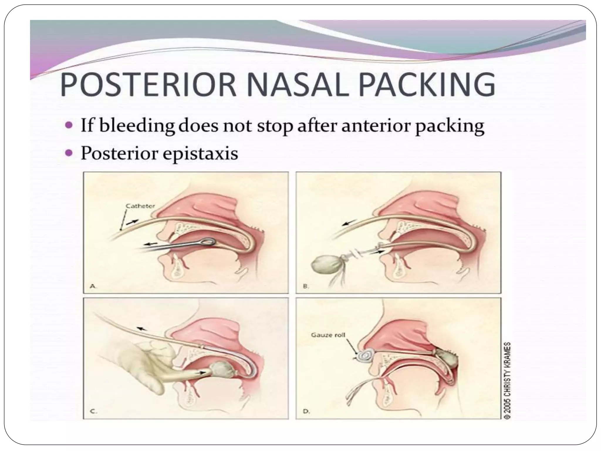 EPISTAXIS.pptx