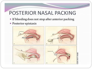 EPISTAXIS.pptx