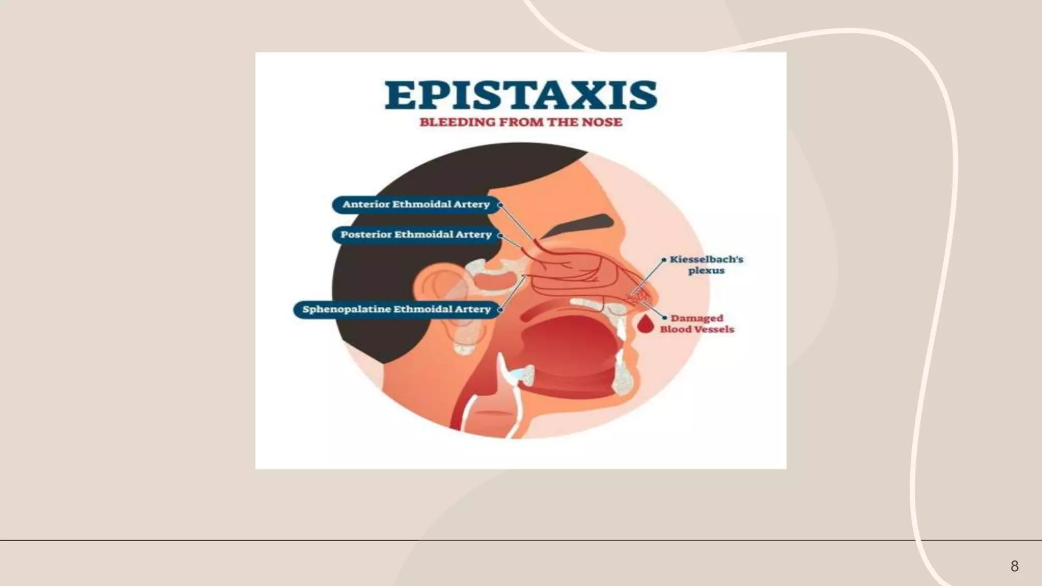 EPISTAXIS.pptx