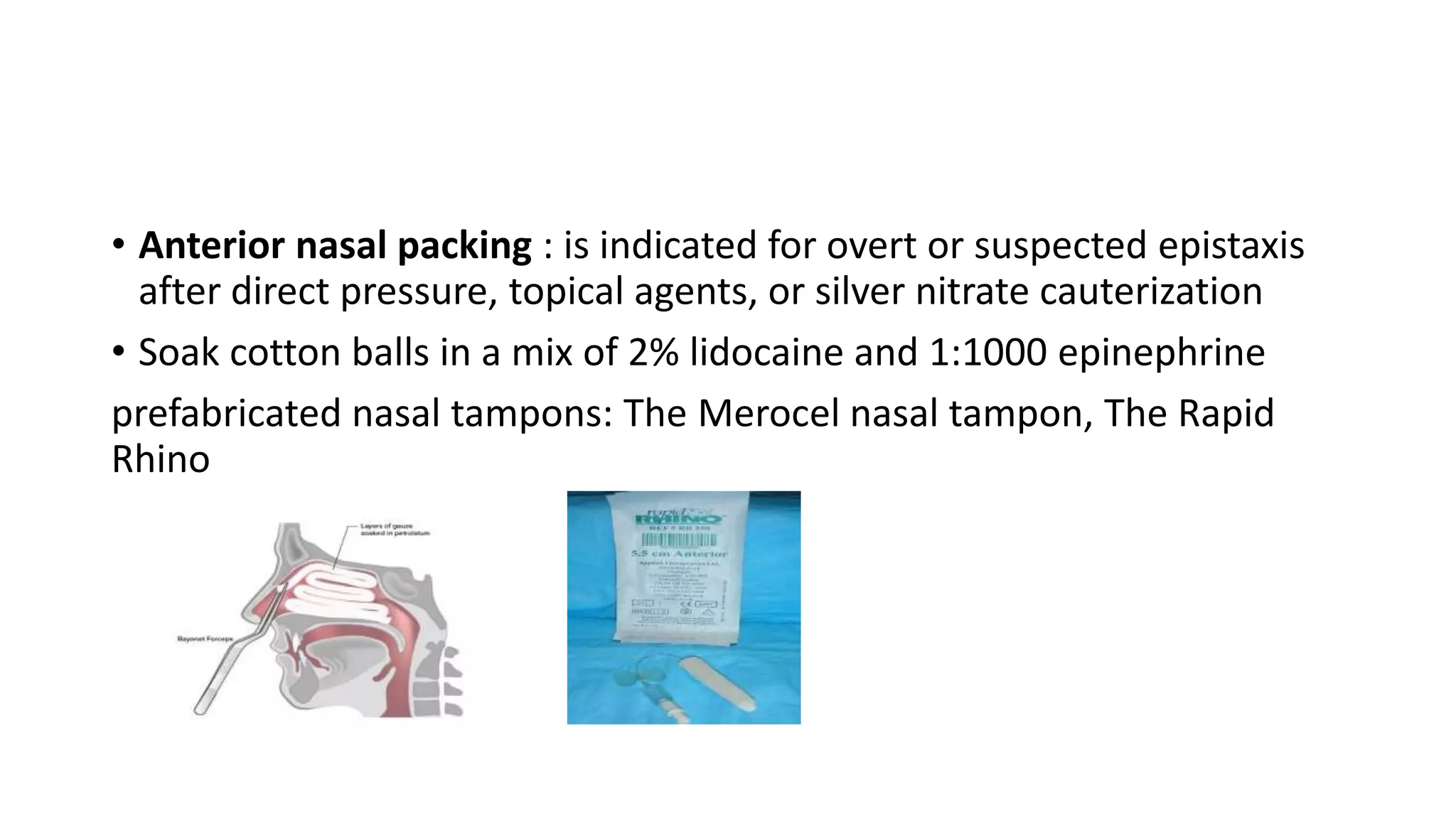 epistaxis.pptx