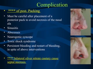 epistaxis.pdf | Ear, Nose and Throat Conditions | Diseases and Conditions