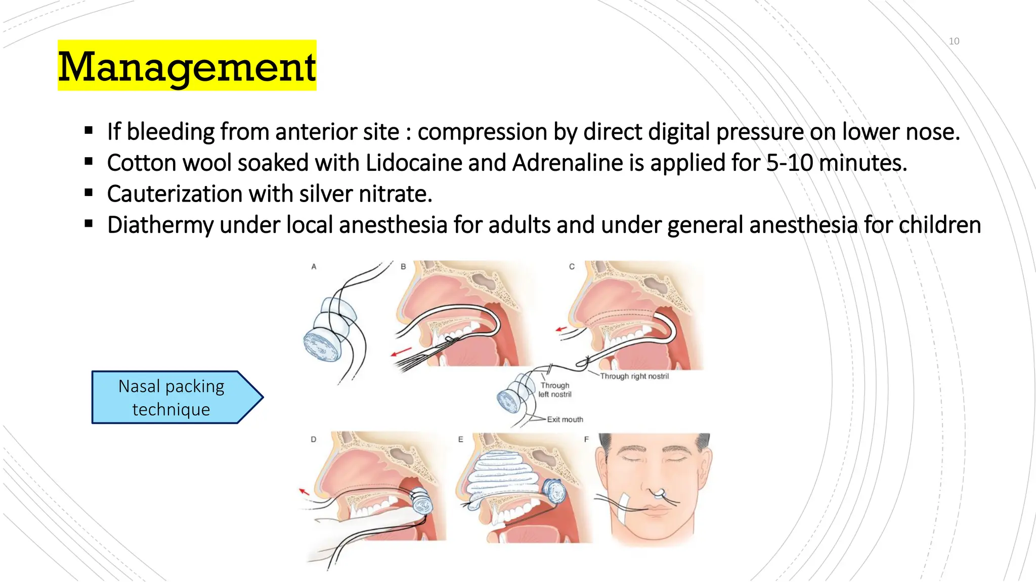 Everything about Epistaxis (nasal bleeding) .pdf