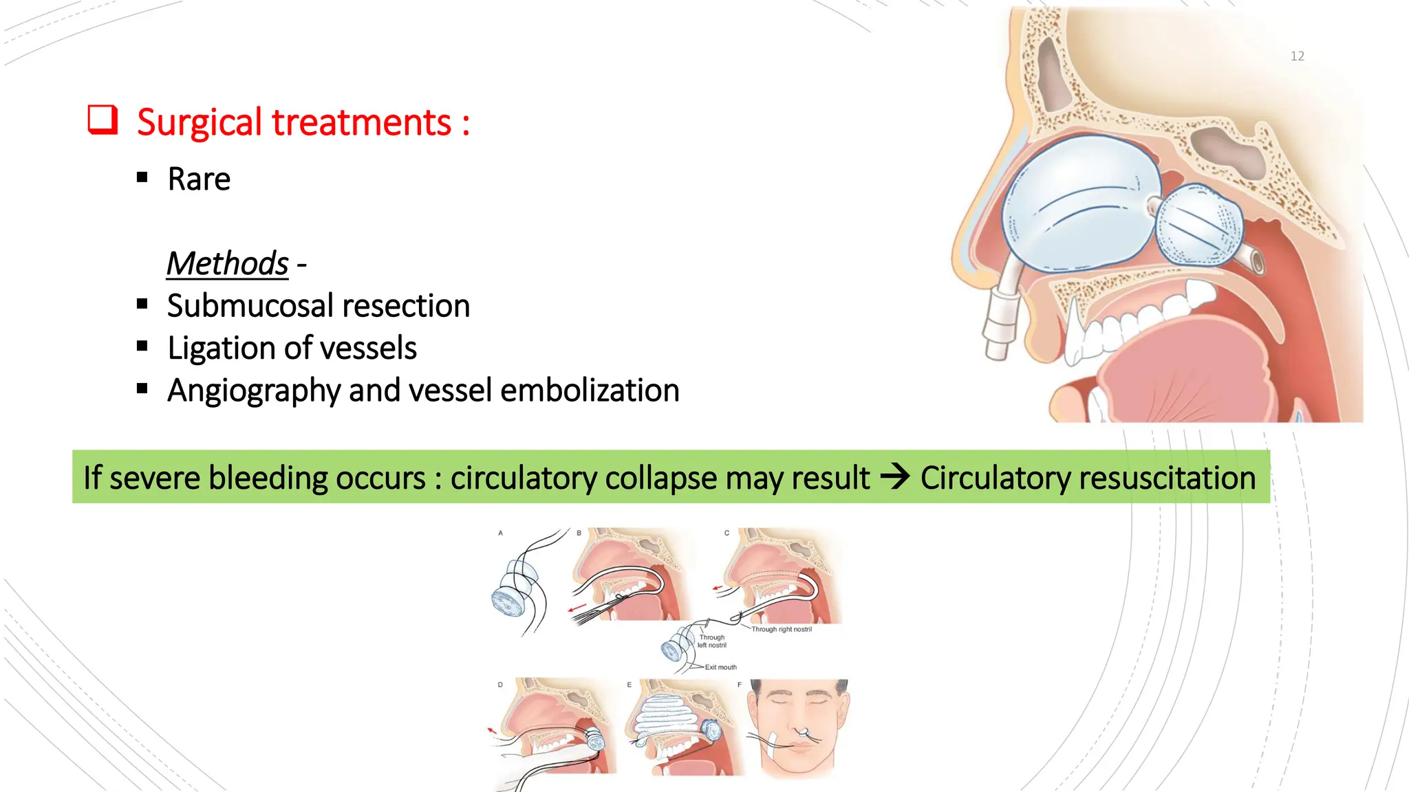 Everything about Epistaxis (nasal bleeding) .pdf