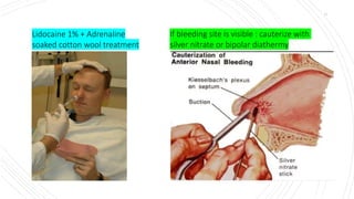 Everything about Epistaxis (nasal bleeding) .pdf