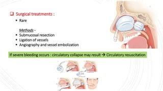 Everything about Epistaxis (nasal bleeding) .pdf