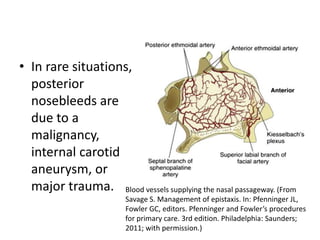 introduction and management of EPISTAXIS.pptx