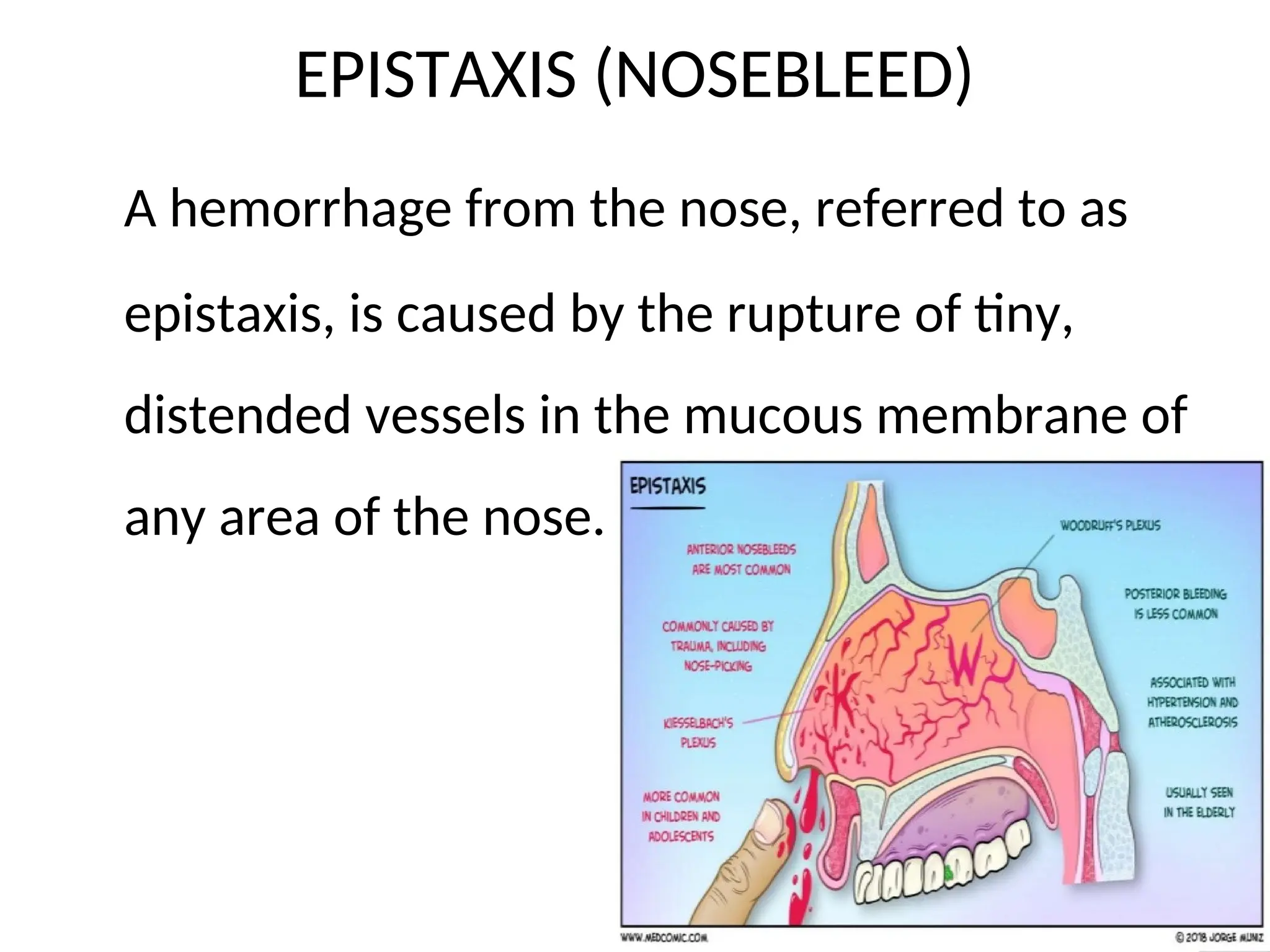 Epistaxis ( Nose Bleeding ) .ppt