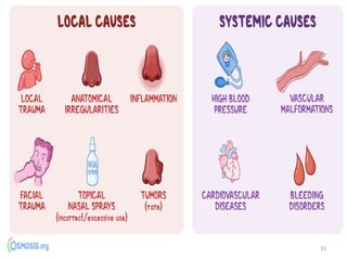 Epistaxis ( Nose Bleeding ) .ppt