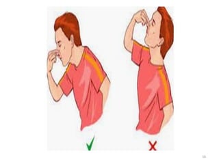 Epistaxis ( Nose Bleeding ) .ppt