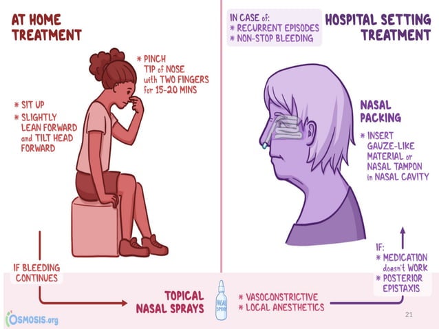 Epistaxis ( Nose Bleeding ) .ppt