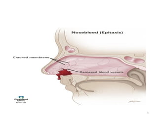 Epistaxis ( Nose Bleeding ) .ppt