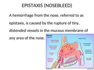 Epistaxis ( Nose Bleeding ) .ppt