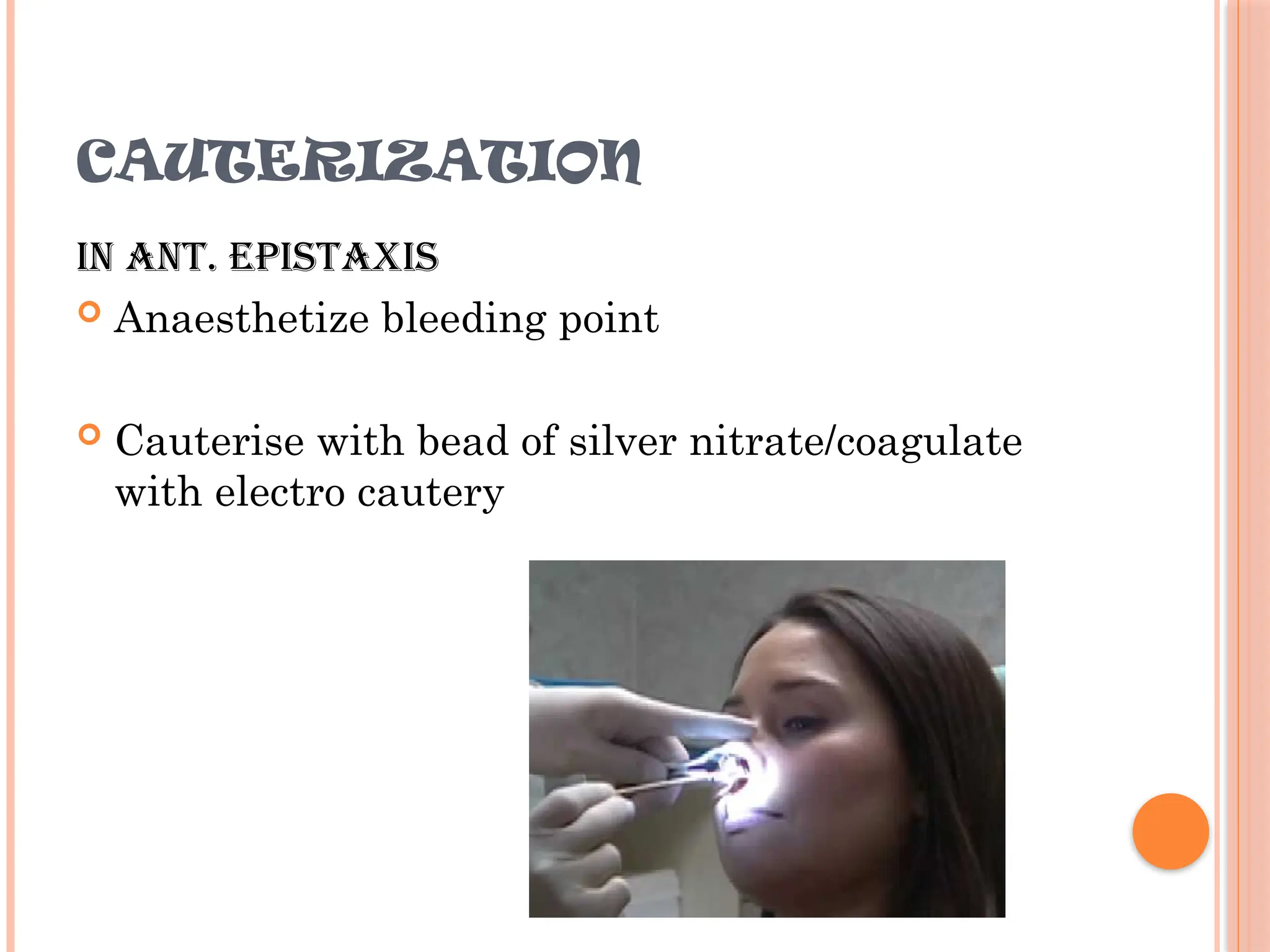 epistaxis management cause cure complete pptx | PPTX