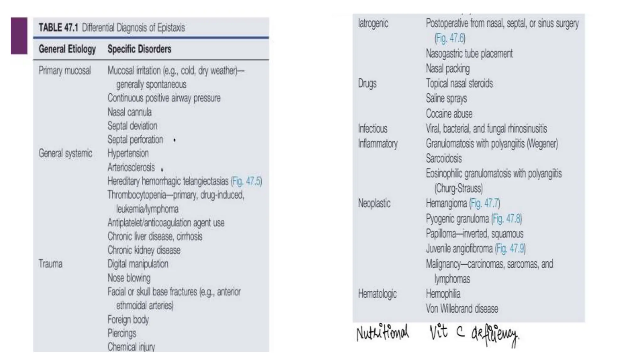 Epistaxis with examination and management of epsisatxis | PPTX