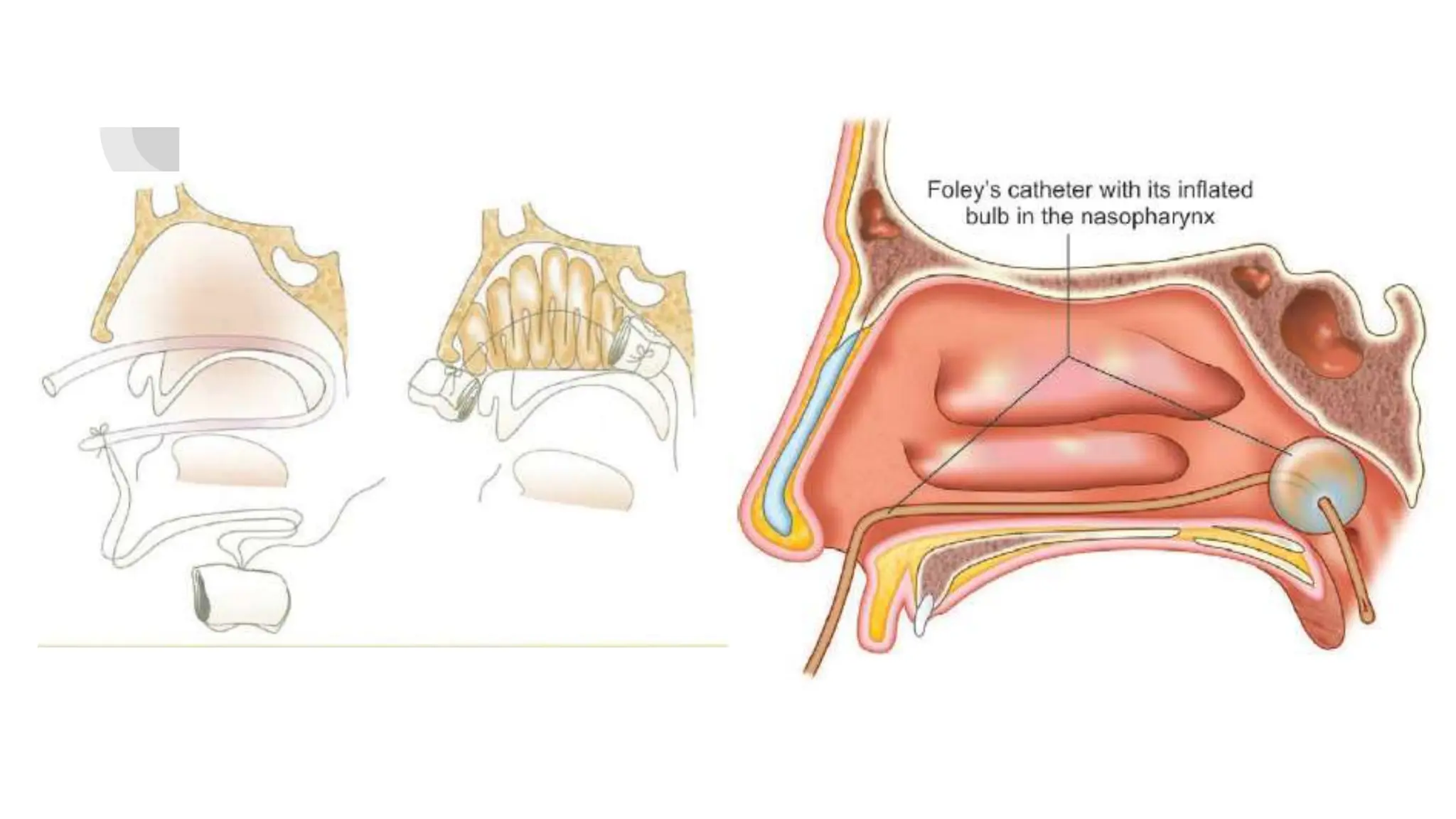 Epistaxis with examination and management of epsisatxis | PPT