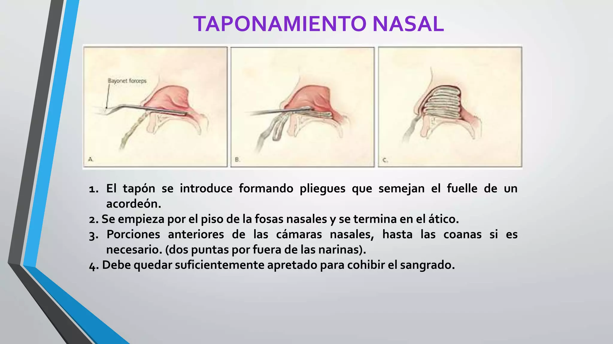 Epistaxis Sangrado Nasal Dr Omar Gonzales Suazo Ppt
