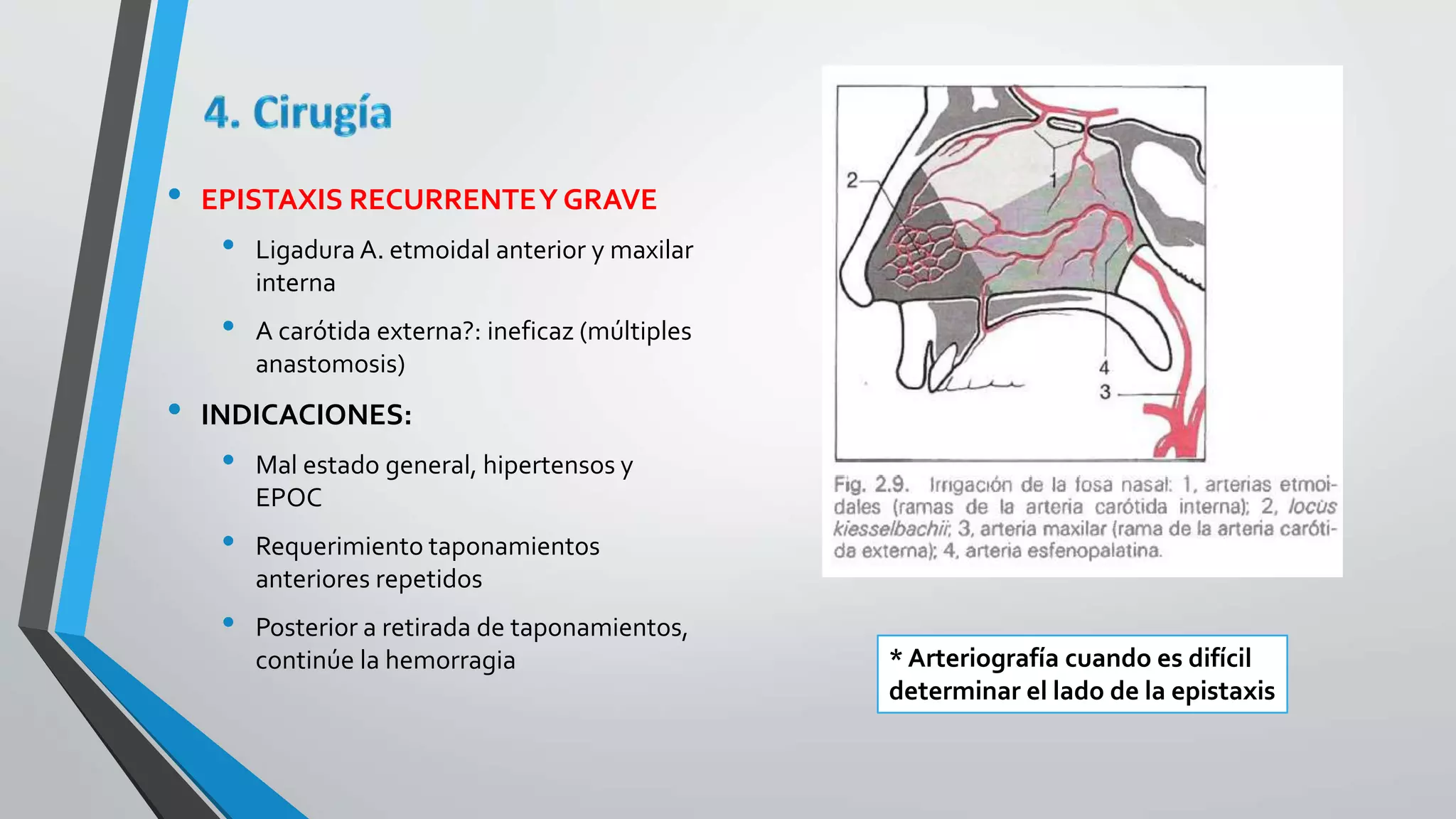 Epistaxis Sangrado Nasal Dr Omar Gonzales Suazo Ppt