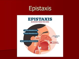 Epistaxis 2 copy.pptxekekekekkekekekekekek | PPT
