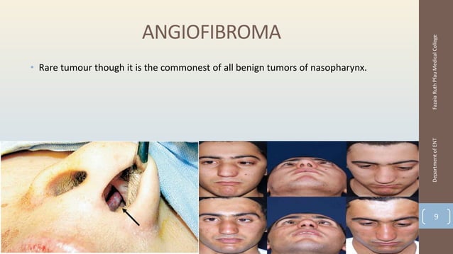 Epistaxis & Angiofibroma.pptx | Free Download
