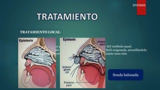 Epistaxis bien.pptx