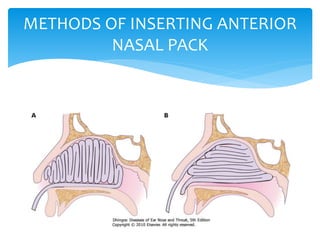 Epistaxis | PPTX
