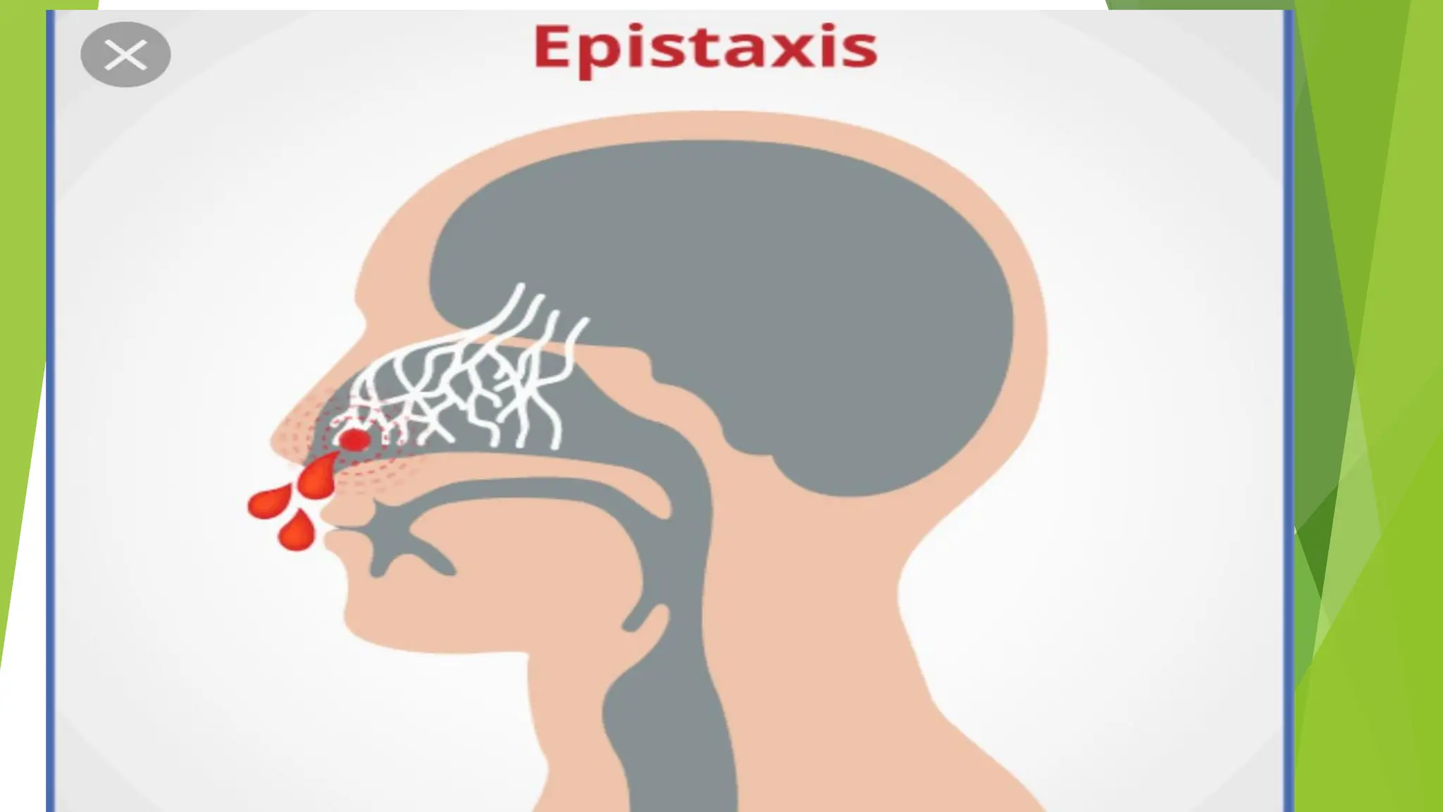 EPISTAXIS final.pdf