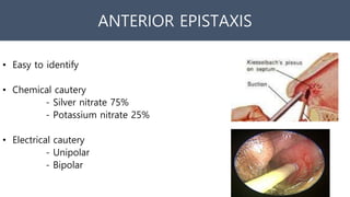 EPISTAXIS | PPT