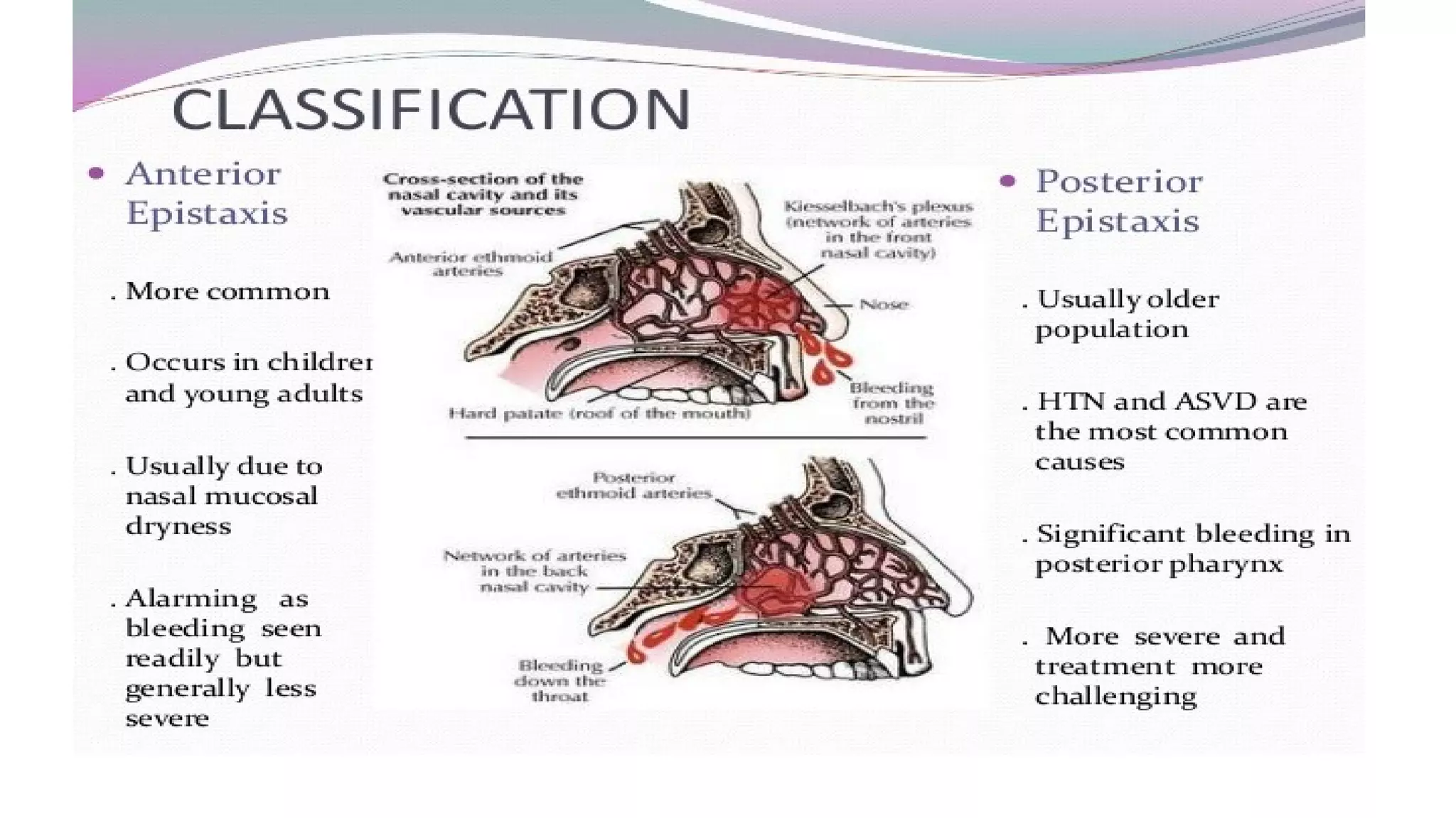 Epistaxis or Nose bleeding | PPT