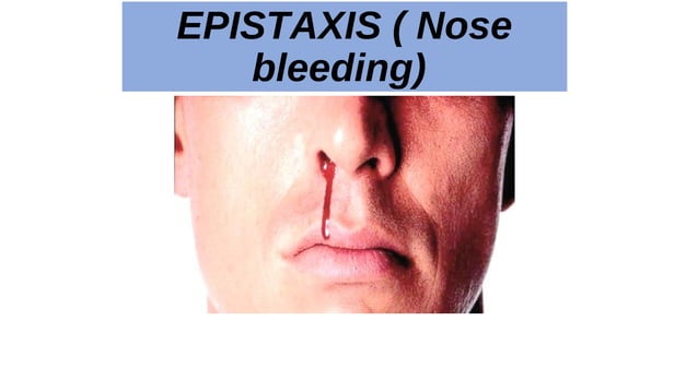 Epistaxis or Nose bleeding | PPT