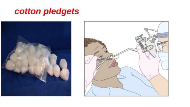 Epistaxis or Nose bleeding | PPT
