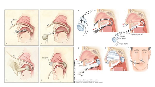 Epistaxis or Nose bleeding | PPT