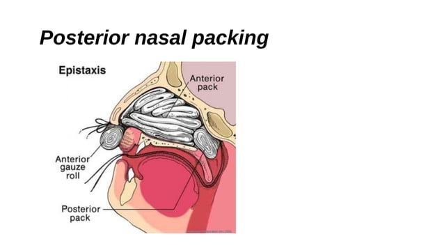 Epistaxis or Nose bleeding | PPT
