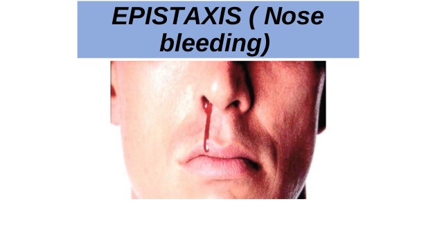 Epistaxis or Nose bleeding