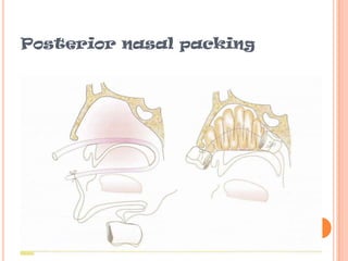 Epistaxis management | PPTX