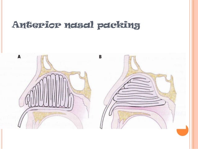 Epistaxis management