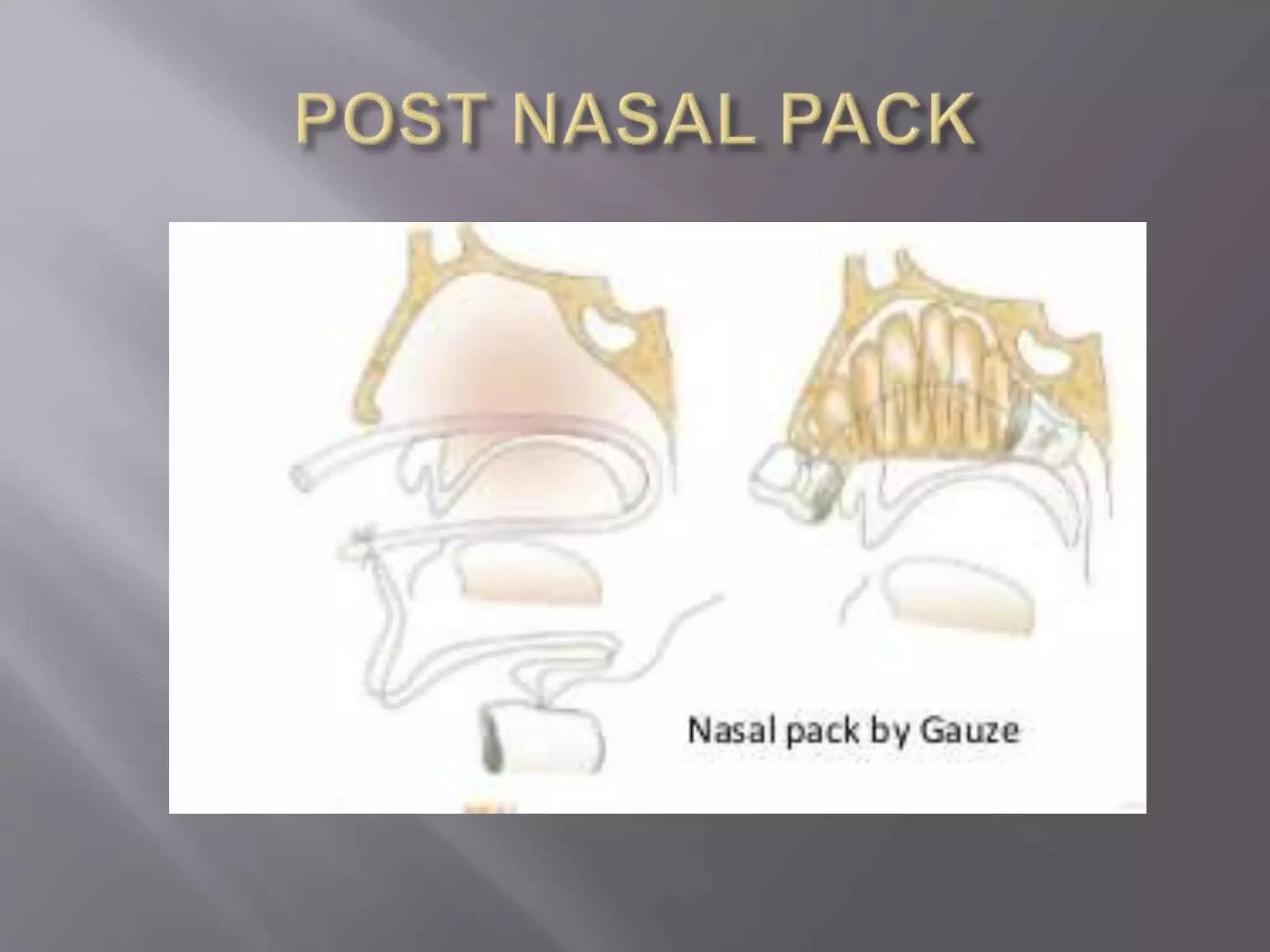 Epistaxis PPT | PPT