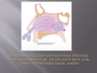 Epistaxis PPT | PPTX