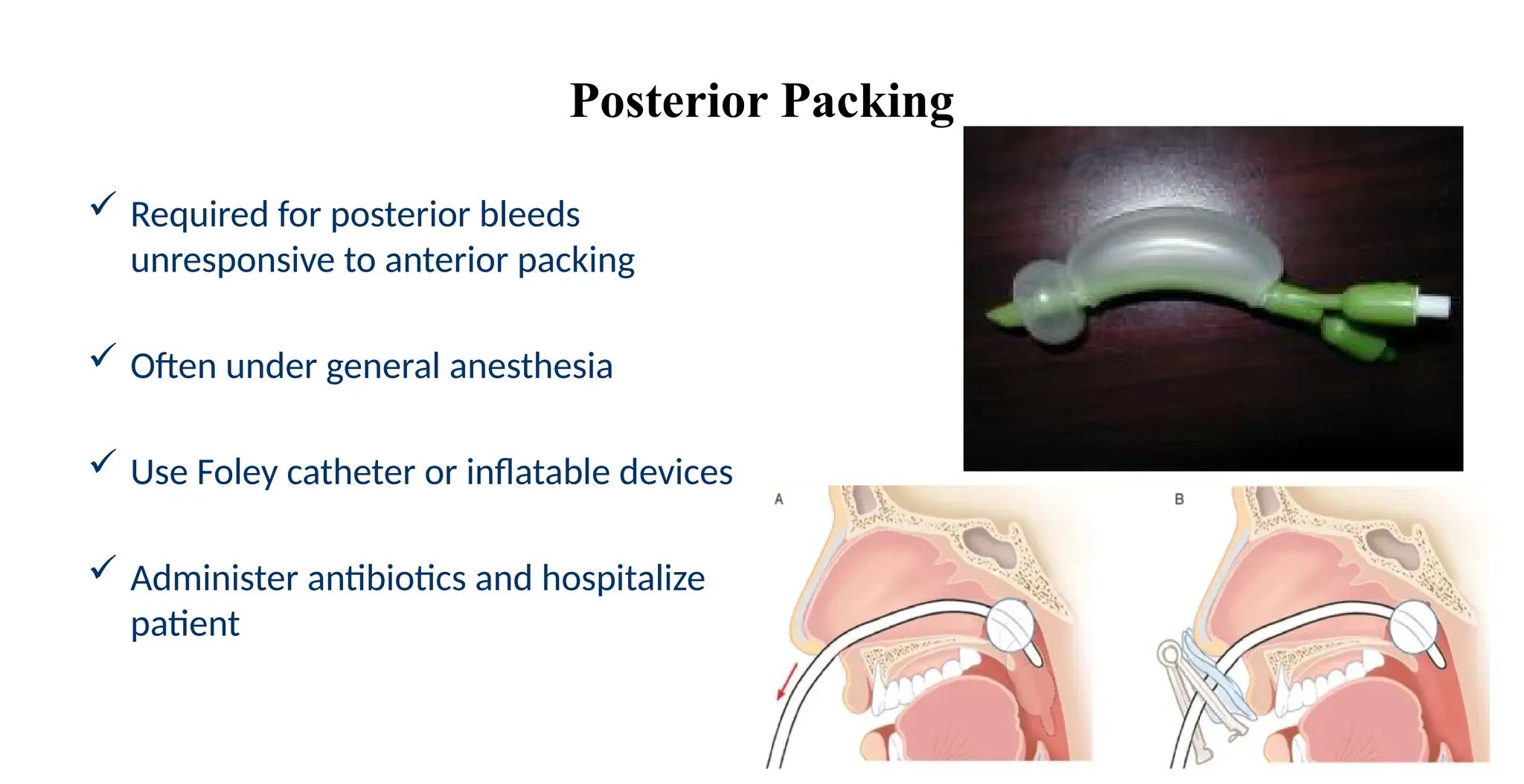 Epistaxis_Presentation_covering-anterior&posterior-bleeds.pptx