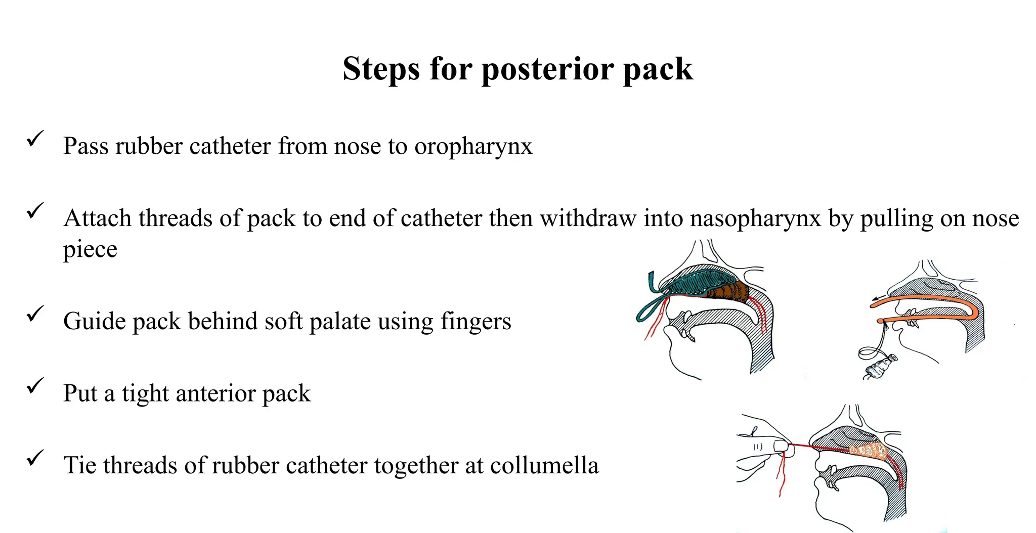 Epistaxis_Presentation_covering-anterior&posterior-bleeds.pptx