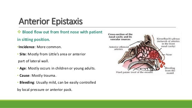 Epistaxis