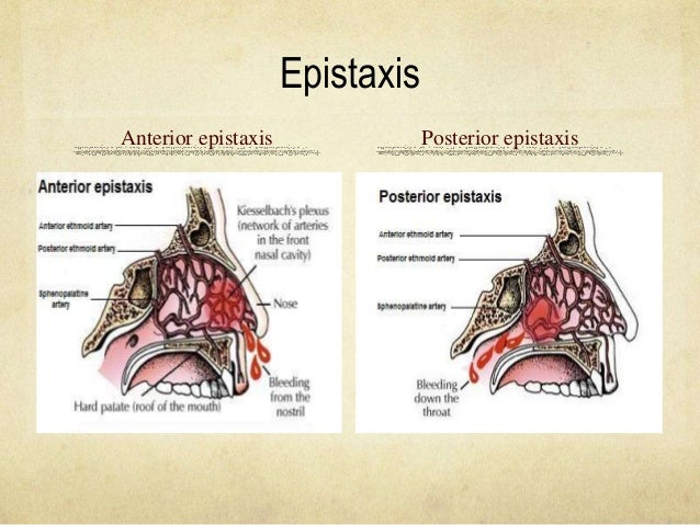 Epistaxis