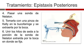 Epistaxis | PPTX
