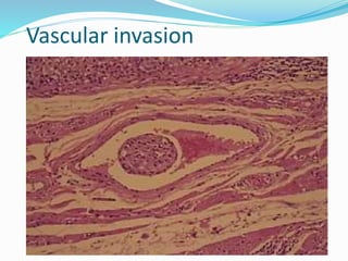 Epithelial and mesenchymal transition in invasion and metastasis | PPTX