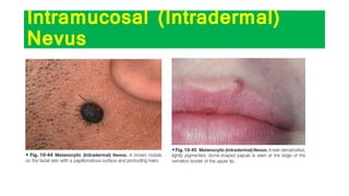 Epithelial Disorders Oral Pathology | PPTX