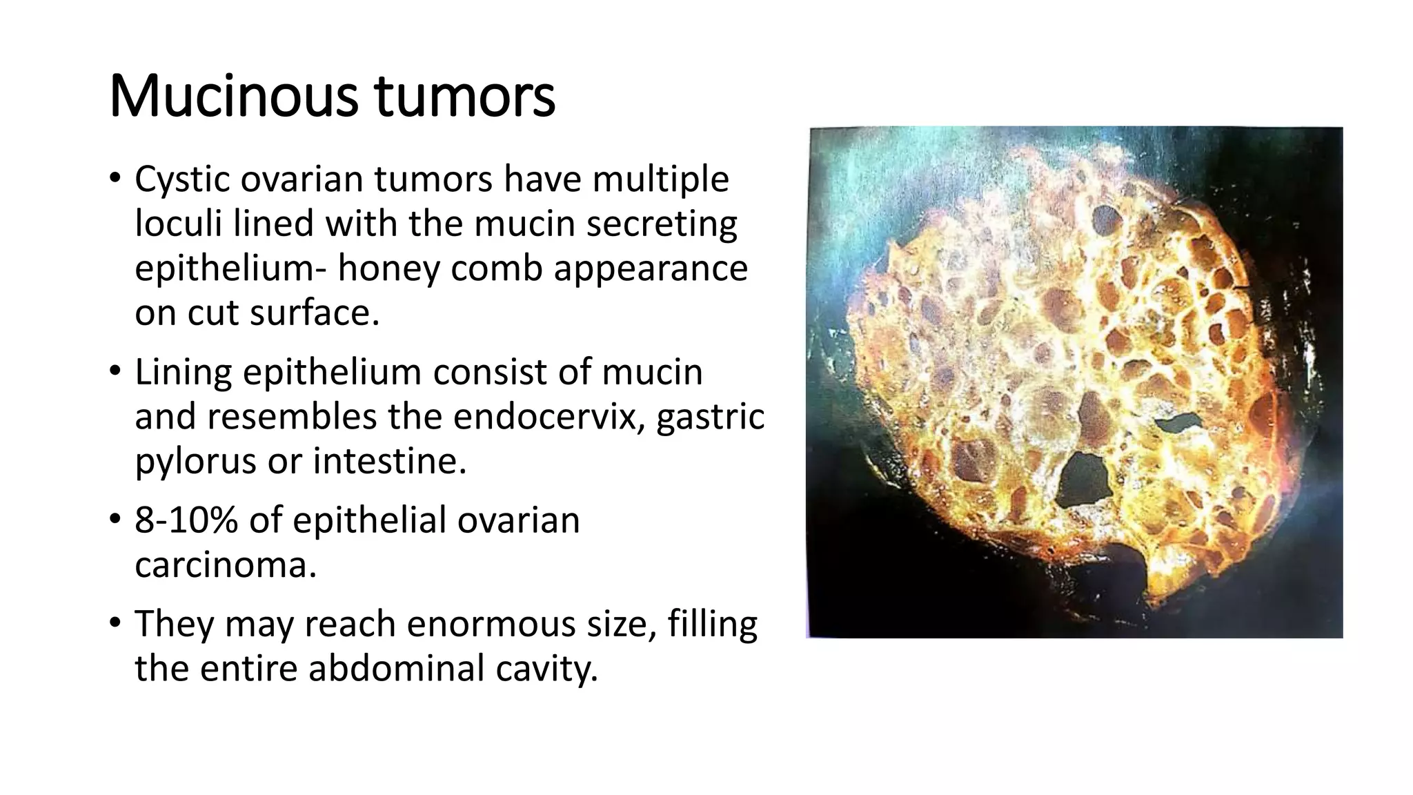 Epithelial ovarian cancer n.pptx