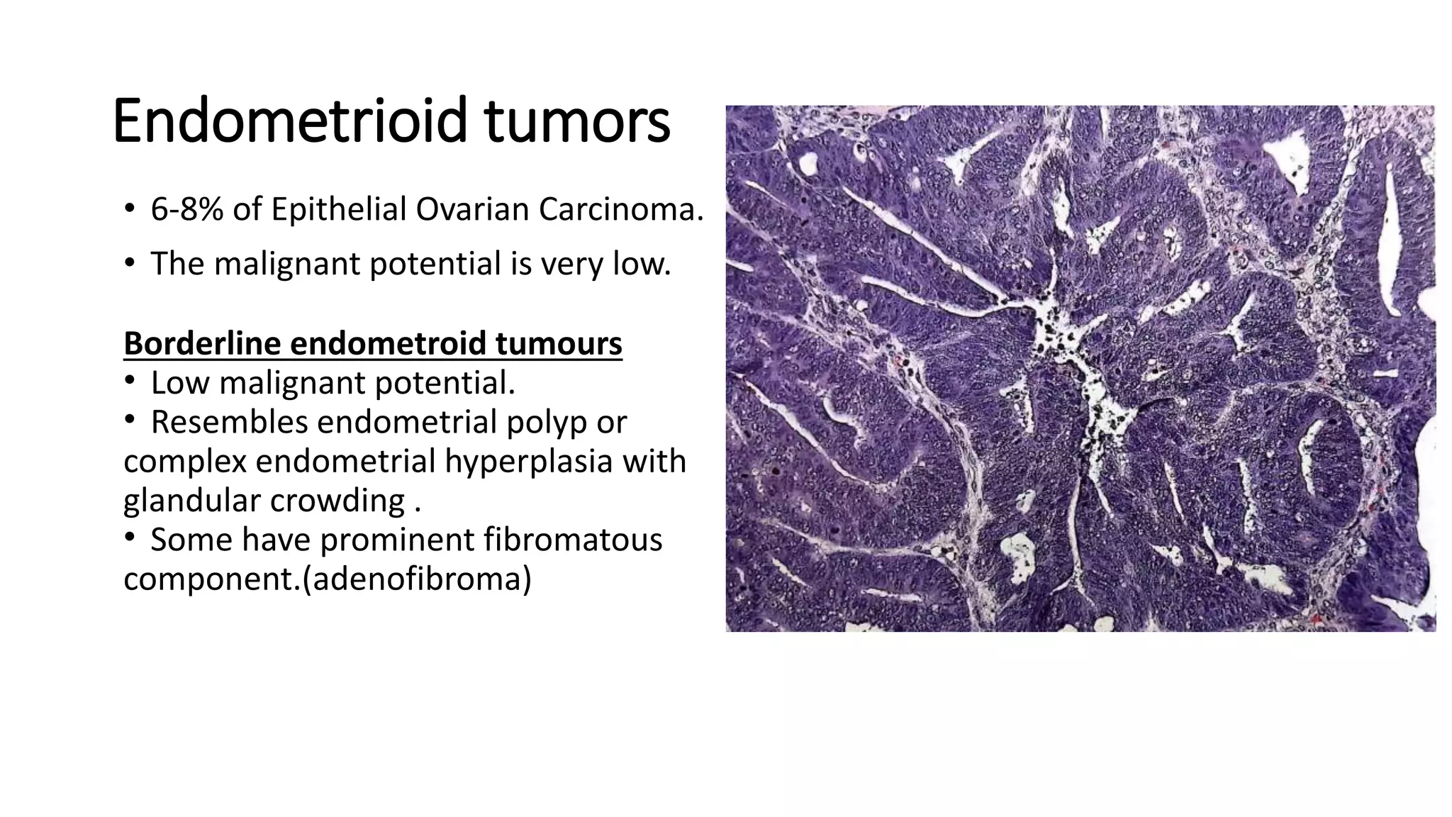 Epithelial ovarian cancer n.pptx